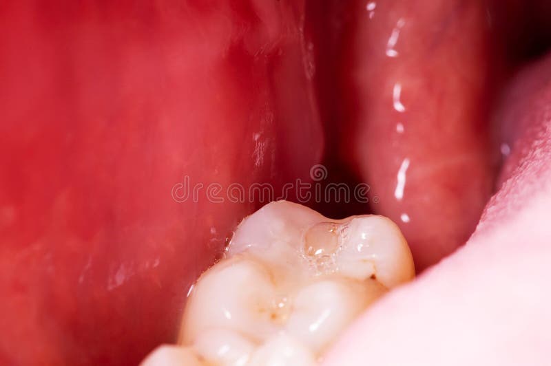 Recess after Complex Impacted Wisdom Tooth Extraction, Traumatic ...