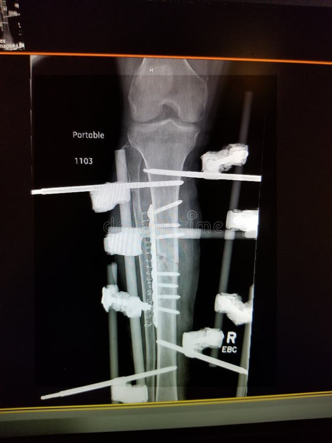 Rechte Tibiafraktur Mit Interner Fixierungshardware Stockfoto - Bild ...