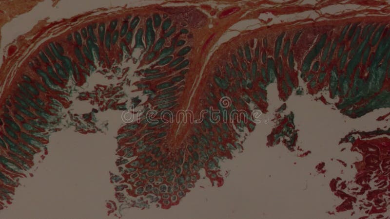 Rectum Carcinoma Tissue Close Up Stock Video - Video of glands, support ...