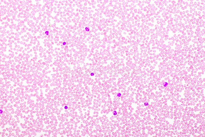 Red Blood Cells and Platelet in Blood Smear Stock Photo - Image of ...