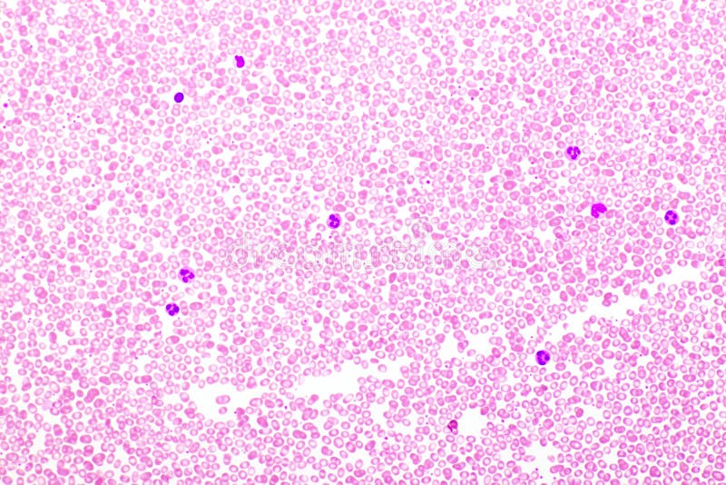 Red Blood Cells and Platelet in Blood Smear Stock Photo - Image of ...