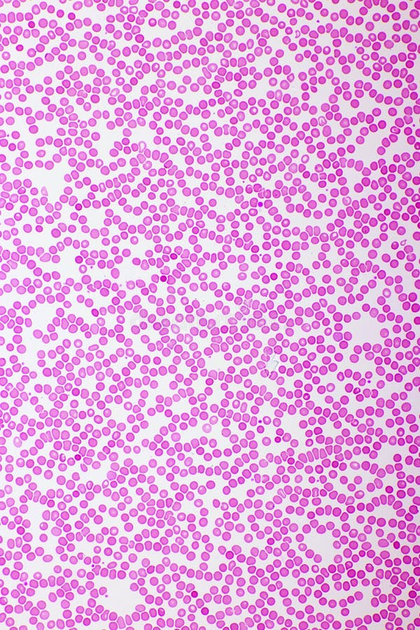 Red Blood Cells in Blood Smear Stock Photo - Image of examination ...
