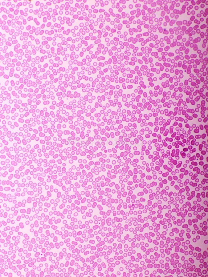 Red Blood Cells in Blood Smear Stock Image - Image of background, burr ...