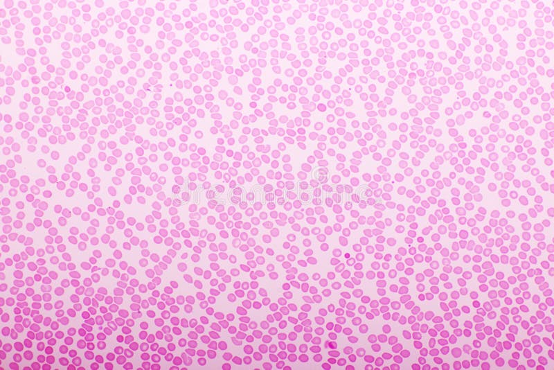 Red Blood Cells in Blood Smear Stock Photo - Image of checkup ...