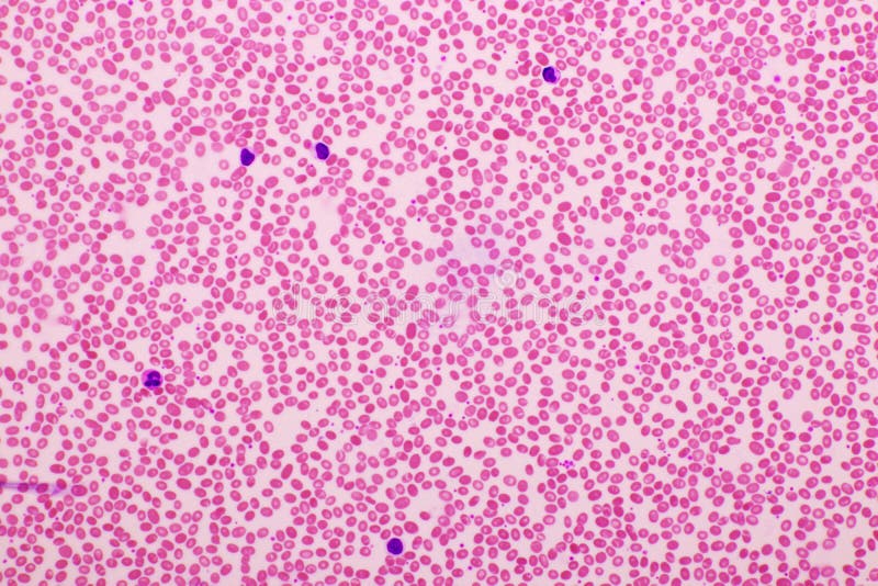 Red Blood Cells in Blood Smear Stock Photo - Image of acanthocyte ...