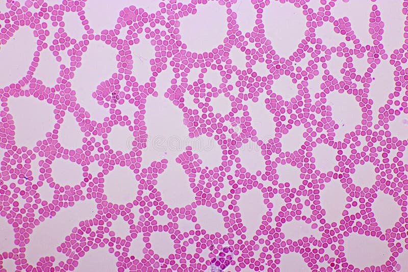 Red Blood Cells and White Blood Cells in Blood Smear Stock Image ...