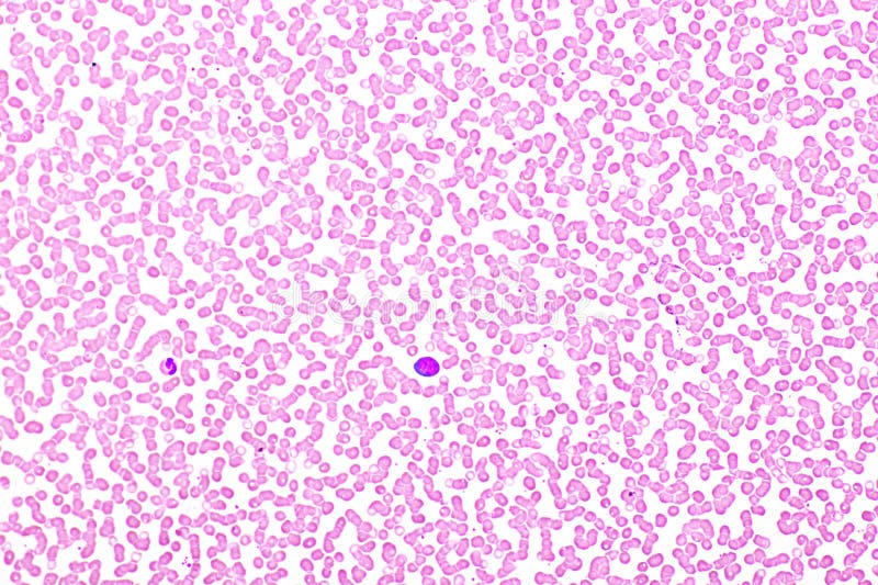 Red Blood Cells and White Blood Cells in Blood Smear Stock Photo ...