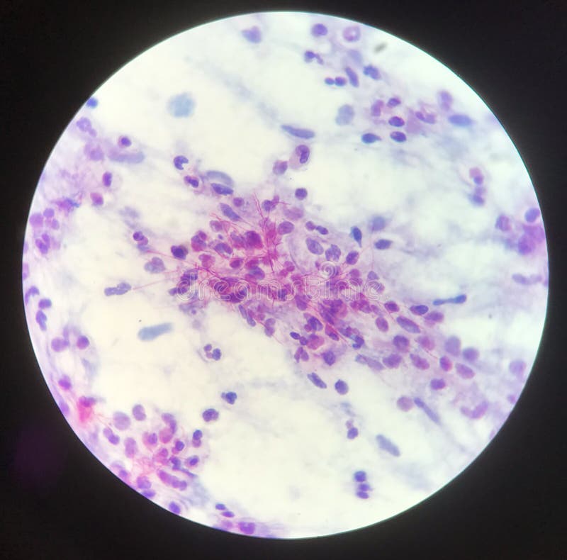 Red Branching Mycobacterium Tuberculosis on Blue Background in Modified ...