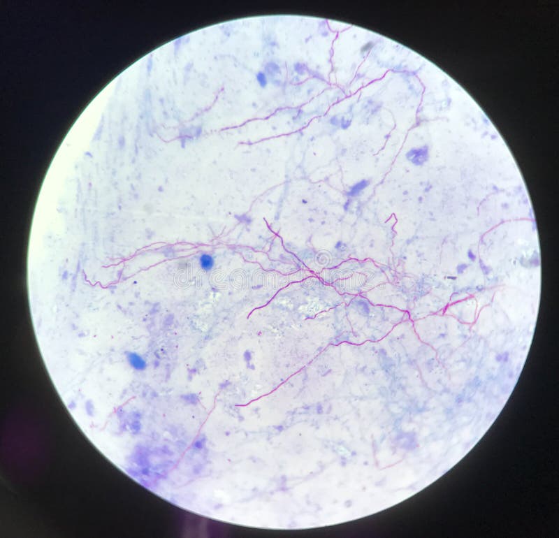 Red Branching Mycobacterium Tuberculosis on Blue Background in Modified ...