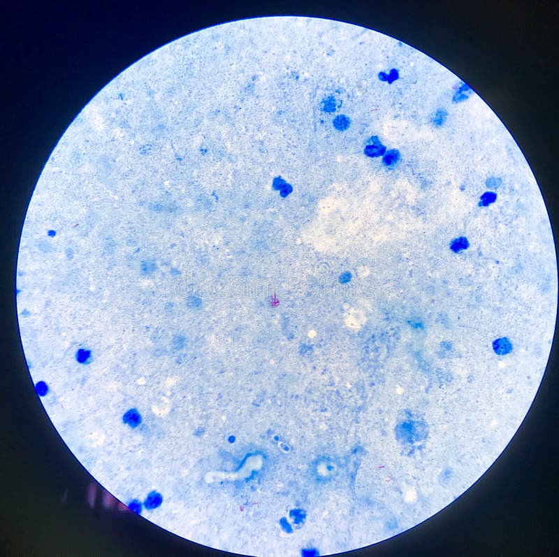 Red Cells on Blue Background Tuberculosis Stock Image - Image of ...