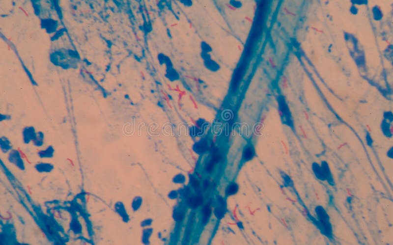 Red Cells Microbacterium Tuberculosis Stock Photo - Image of bacterium ...
