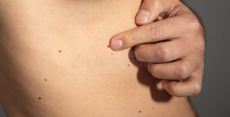 Red dots on the human body stock image. Image of lesion - 349142935