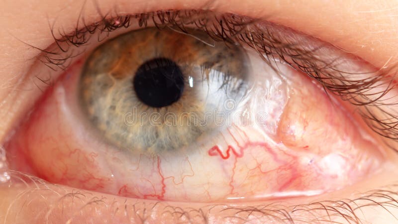 Red Eye on Face after Surgery Stock Image - Image of medicine ...