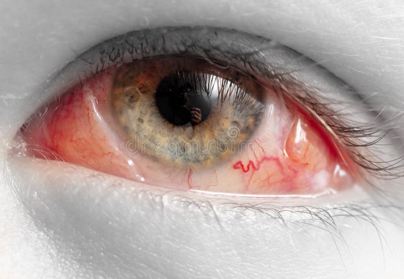 Red Eye on Face after Surgery Stock Image - Image of retina, medicine ...
