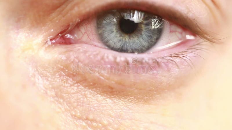 Red Eye with Tears - Close-up Stock Video - Video of iris, macula: 70179385