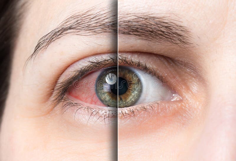 Red Eye before and after Treatment Stock Image - Image of ...