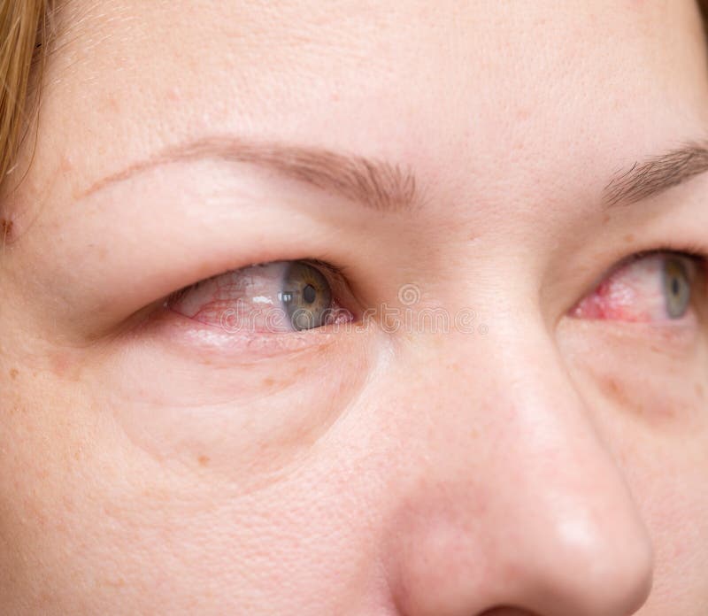 Red eyes stock photo. Image of bloodshot, woman, conjunctivitis - 102612474
