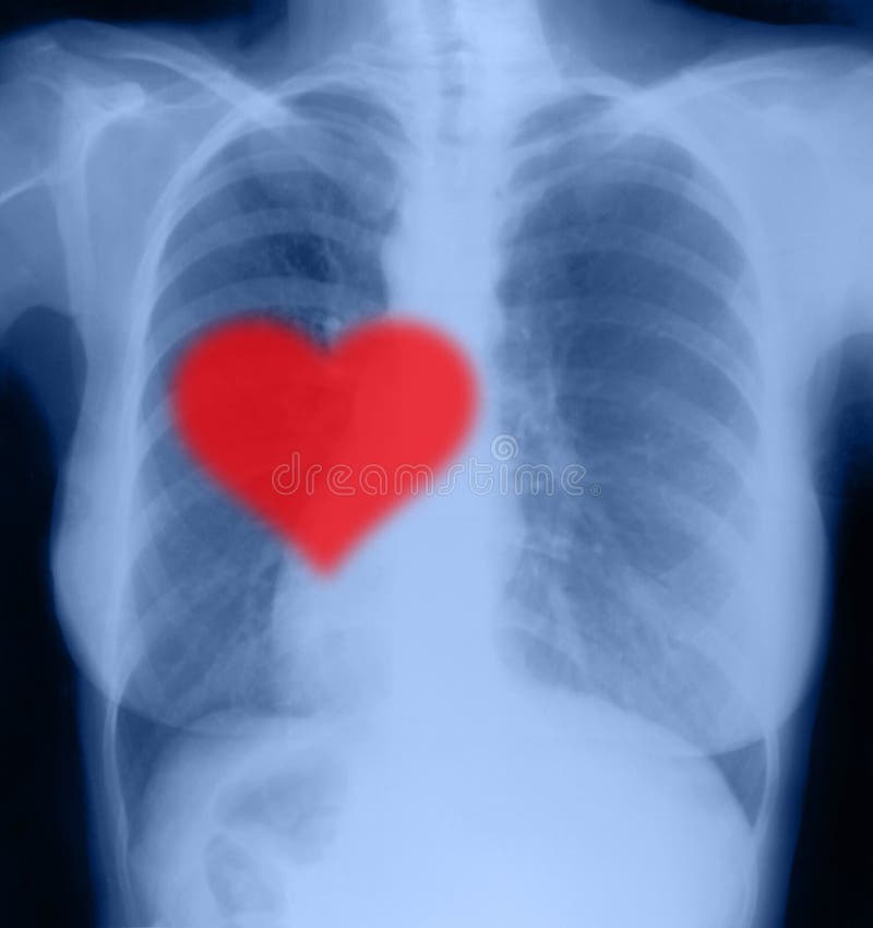 X Ray Heart Stock Photos - Download 3,411 Royalty Free Photos