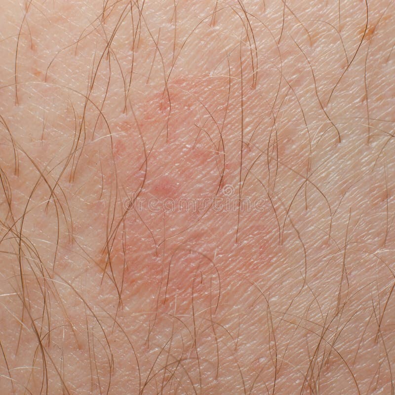 Red Itchy Skin Rash Closeup Macro Stock Photo - Image of irritation ...