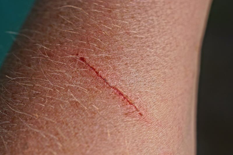 Hand Man Injured Wound Accident Blood Bleeding Photos - Free & Royalty ...