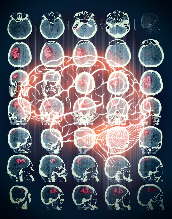 Red Marked Zone on the CT Scan of Human Brain Stock Image - Image of ...