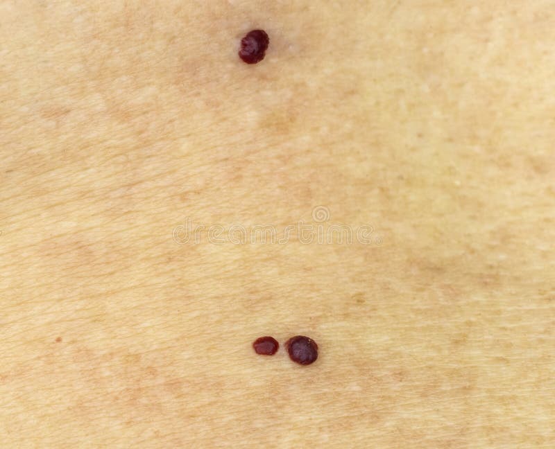 Red Moles on Caucasian Skin, Cherry Angioma Stock Image - Image of ... Red Moles on Caucasian Skin, Cherry Angioma Stock Image - Image of ...