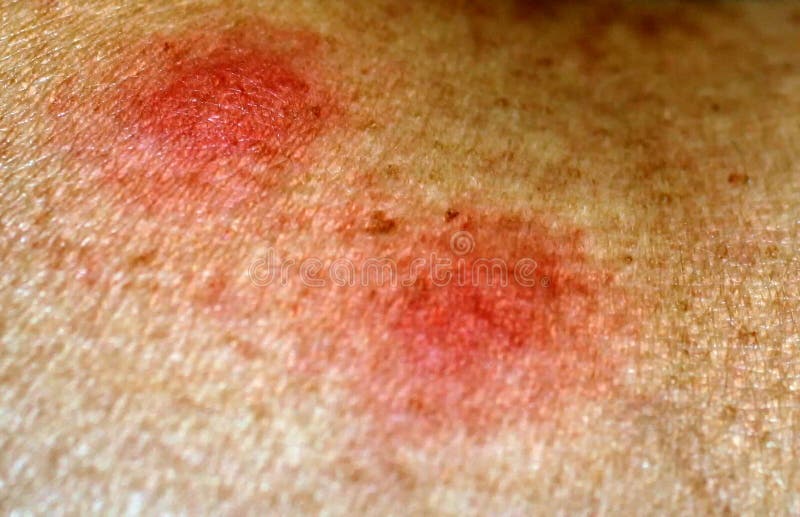Red Mosquito Bites. Swelling of the Skin. a Bite of a Wasp, a Bee ...