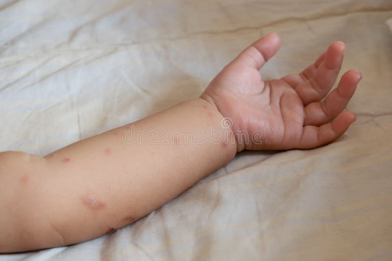 Red Rash Caused by Infant Arm Infection Stock Image - Image of infant ...