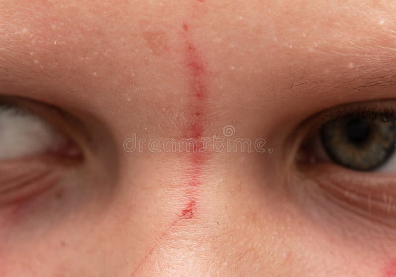 Red scratch on the face stock photo. Image of damaged - 210272916