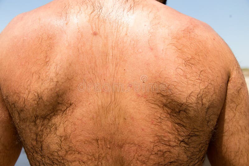 Red Skin Tan on the Back of a Man Stock Image - Image of peeling ...