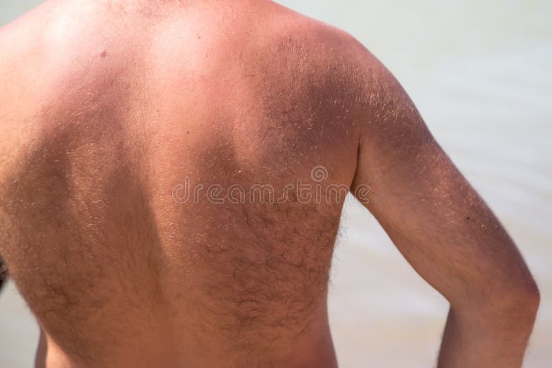 Red Skin Tan on the Back of a Man Stock Image - Image of summer ...