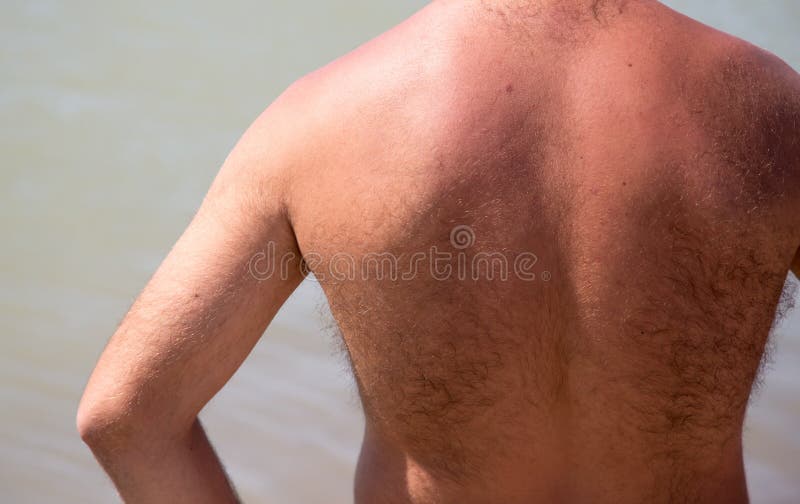 Red Skin Tan on the Back of a Man Stock Image - Image of white, pain ...