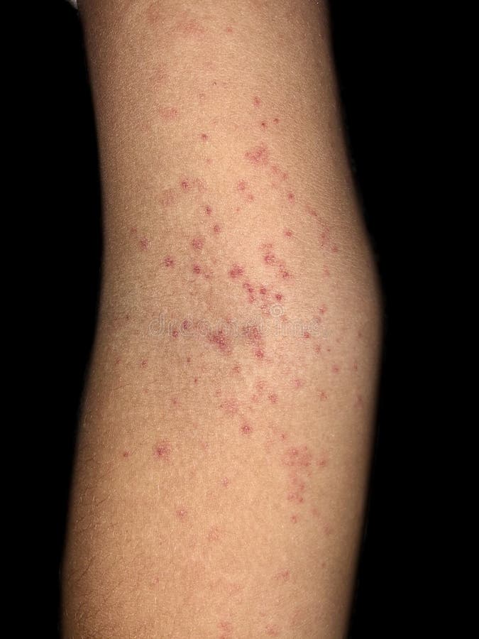 Red Spots in Cubital Fossa. Hess’s Test Positive. Dengue Hemorrhagic ... Red Spots in Cubital Fossa. Hess’s Test Positive. Dengue Hemorrhagic ...