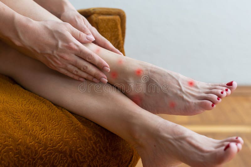 Red spots on the hands stock photo. Image of eczema - 262322442
