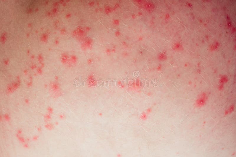 Red Spots on the Skin Close Up Stock Image - Image of medicine, obesity ...