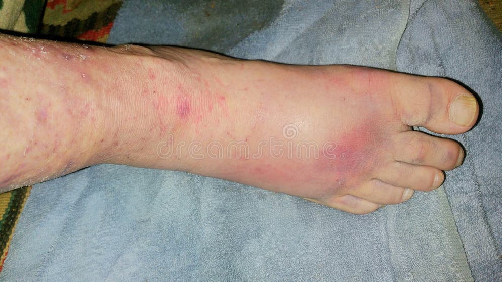 Red Swollen and Bruised Foot Stock Image - Image of swollen, limb ...