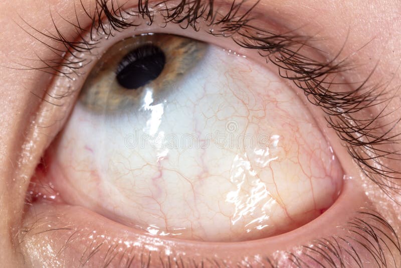 Red Veins in the Eye of a Boy Stock Photo - Image of head, vienna ...