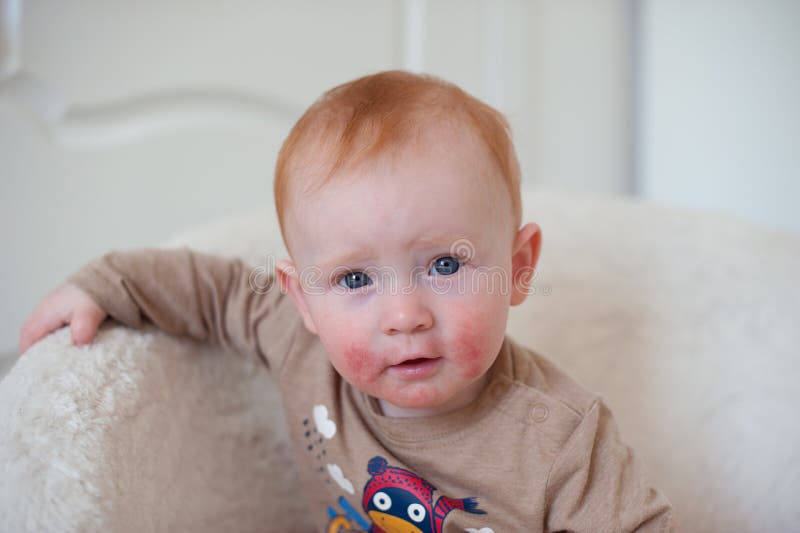 Redhead Baby with Atopic Dermatitis Stock Image - Image of dermatitis ...
