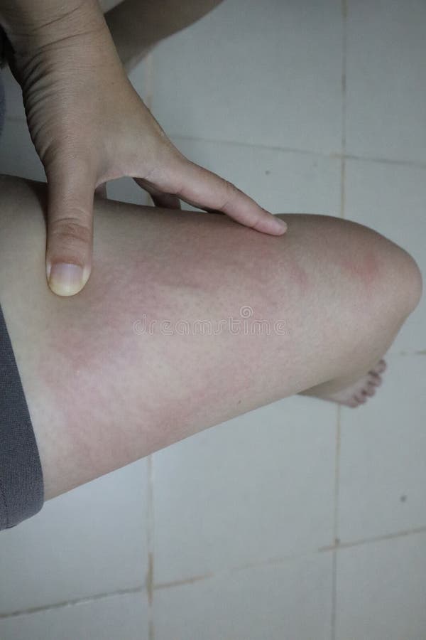 Redness Lesions on the Skin, Legs, Women Stock Photo - Image of redness ...