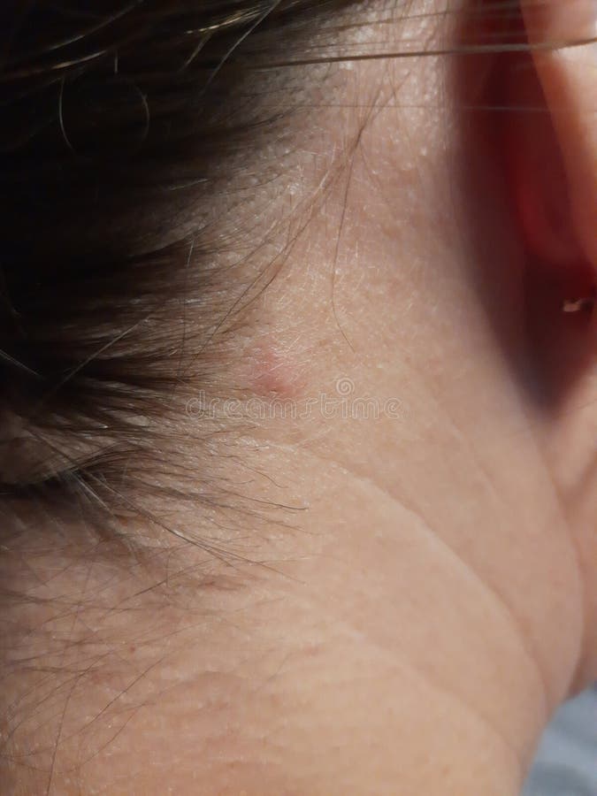 Redness on the Woman& X27;s Neck, Possibly an Insect Bite. Stock Photo ...