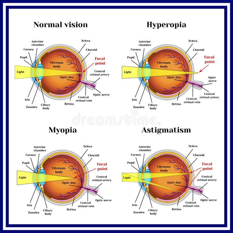 Refractive Errors Eyeball: Hyperopia, Myopia, Astigmatism. Stock Vector ...