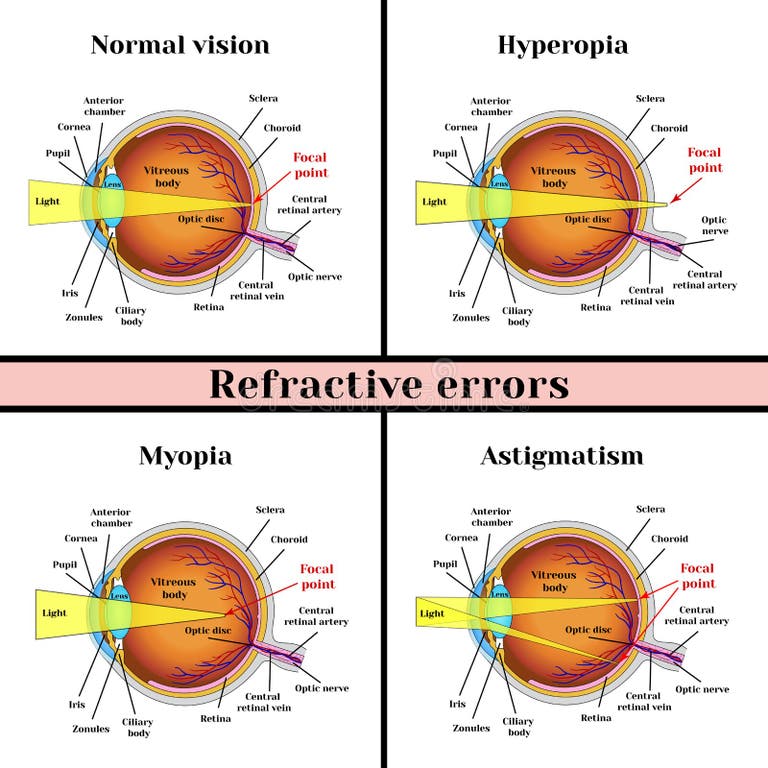 Refractive Errors Eyeball: Hyperopia, Myopia, Astigmatism. Stock Vector ...