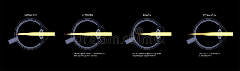 Refractive errors poster stock vector. Illustration of nearsightedness ...
