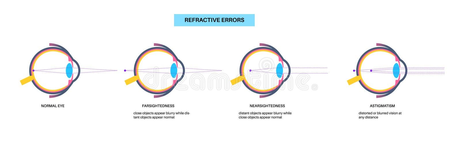 Retina Refractive Error Stock Illustrations – 54 Retina Refractive ...