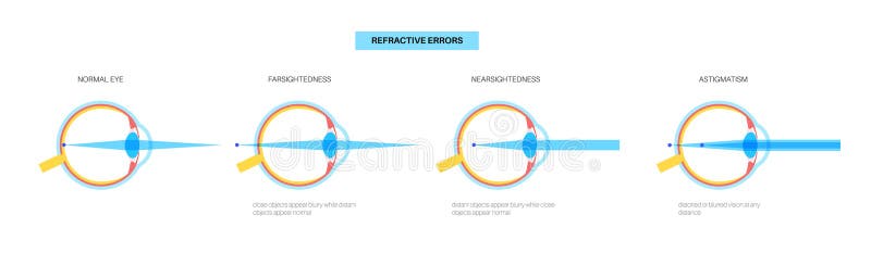 Refractive errors poster stock vector. Illustration of anatomy - 302544344