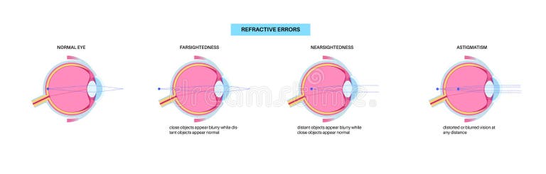 Refractive errors poster stock vector. Illustration of farsightedness ...