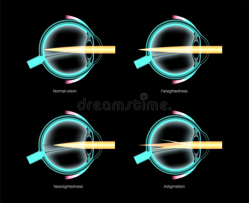 Refractive errors poster stock vector. Illustration of error - 352765758
