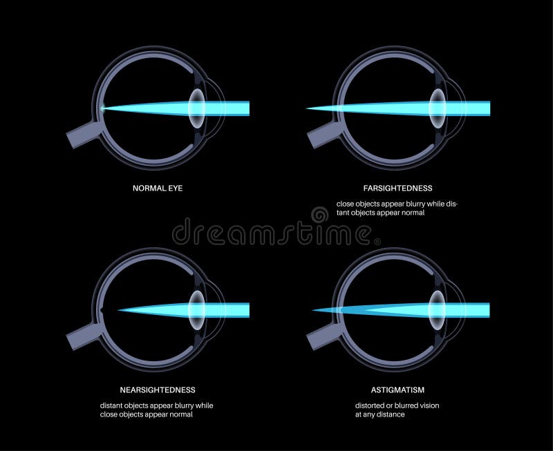 Refractive errors poster stock illustration. Illustration of short ...