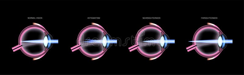 Refractive errors poster stock vector. Illustration of error - 354632953