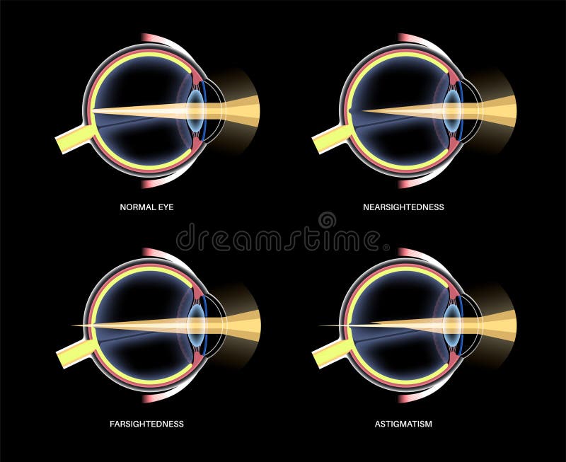 Refractive errors poster stock illustration. Illustration of vector ...